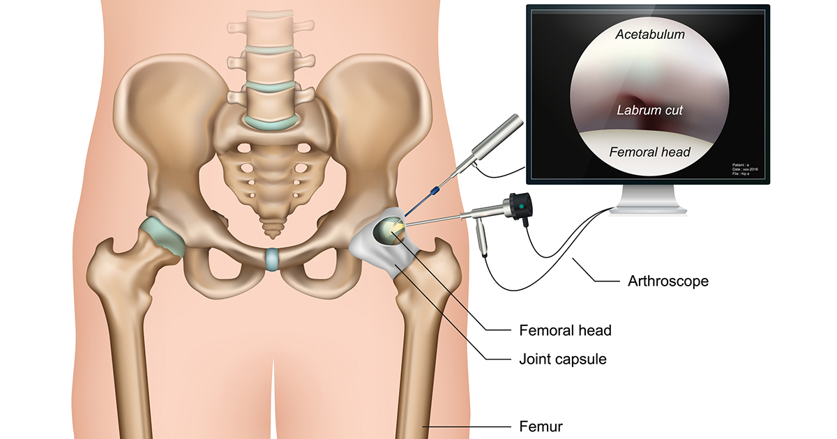 Advancements in Hip Arthroscopy to Prevent Arthritis
