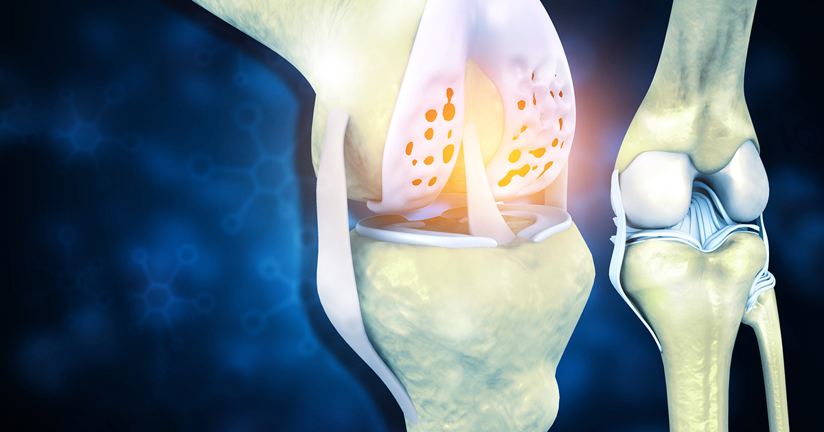 Cartilage Restoration Techniques Chicago IL | Hip Arthritis Chicago