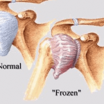 Frozen Shoulder Treatment Des Plaines | Adhesive Capsulitis Treatment ...