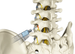 Lumbar Spinal Injections Houston | Low Back Pain Pearland | Spine ...