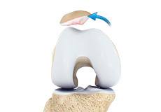 Patellar Dislocation Houston | Kneecap Treatment Pearland | Swollen ...