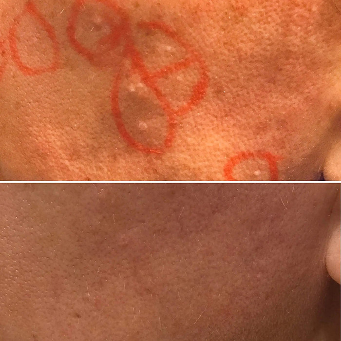 Milia Removal NYC - Debra Jaliman, MD