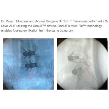 In the News | Dr Payam Moazzaz | Degenerative Disc Disease Oceanside