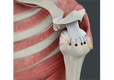 Shoulder Arthroscopy Southington | Rotator Cuff Repair Wallingford, Meriden