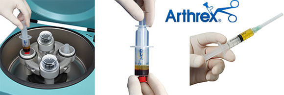 ACP Clinical Trial Chicago | Autologous Conditioned Plasma Treatment ...