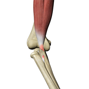 Distal Biceps Avulsion Columbia | Biceps Tendon Tear Columbia