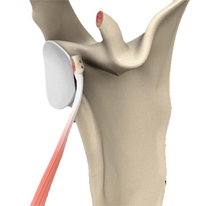 Latarjet Procedure Columbia | Shoulder Instability Columbia