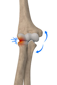 Lateral Impingement of the Elbow Columbia | Cortisone Injection Columbia
