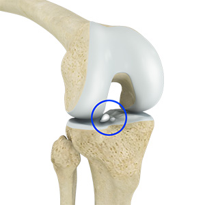 Loose Bodies in the Knee Columbia | Knee Arthroscopy Lexington