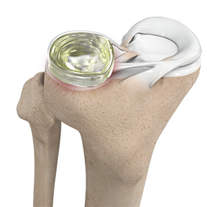 Meniscus Replacement Surgery Columbia | Meniscus Tear Lexington