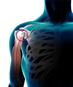 Proximal Biceps Tendon Rupture Columbia | Shoulder Impingement Columbia