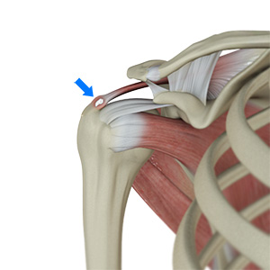 Rotator Cuff Calcification Columbia | Arthroscopic Surgery Columbia