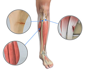 Shin Splints Columbia | Tendonitis Lexington | Stress Fracture Irmo