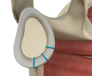 Shoulder Labral Tears Columbia | SLAP Tear Columbia