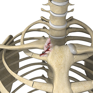 Sternoclavicular Joint Reconstruction Columbia | Sternoclavicular ...