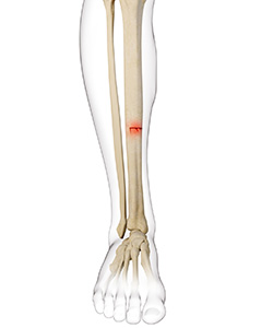 Stress Fracture of the Tibia Columbia | Hairline Fracture Lexington ...