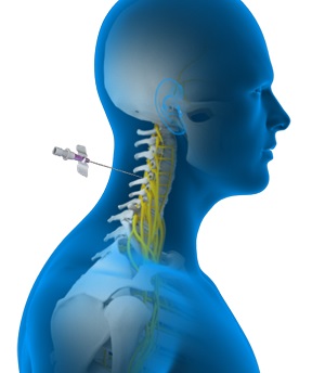 Cervical Epidurals | Advanced Orthopaedics & Sports Medicine ...