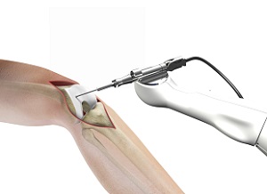 Computer Navigation for Total Knee Replacement | Advanced Orthopaedics ...