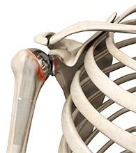 Revision Shoulder Replacement Salt Lake City | Total Shoulder ...