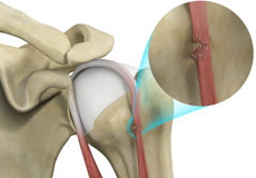 Biceps Tendon Rupture Houston, TX | Biceps Tendon Tears Houston, TX