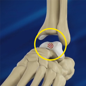 Ankle Arthroscopy Leicester | Ankle Chondral Surgery Leicester