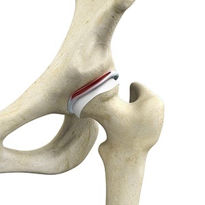 Hip Labral Repair Leicester | Hip Arthroscopy Leicester | Hip ...