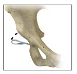 Hip Arthroscopy Kansas City | Hip Reconstruction | Hip Fracture Surgery ...