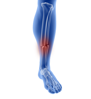 Tibia Fractures Overland Park | Stress Fracture Kansas City | Knee Pain ...