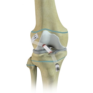 Partial Transphyseal Surgery Overland Park | ACL Reconstruction Lee’s ...