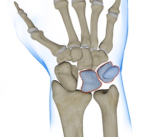 Triquetrolunate Instability Kansas City | Hand Surgery | Wrist Surgery ...