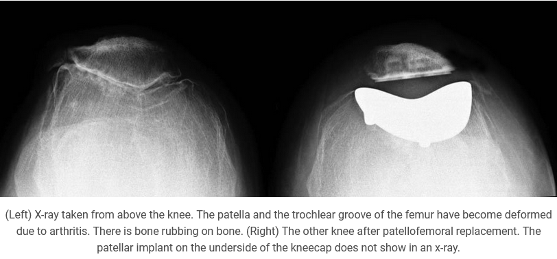 Patellofemoral Arthritis | Orthopedic Surgeon | Joint Replacement ...