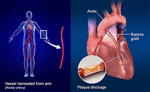 Coronary Artery Bypass Grafting Caribbean Islands | Coronary Artery ...