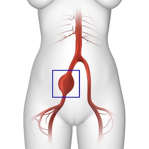 Arterial Disease Ft Lauderdale | Peripheral Aneurysm Miami | Carotid Artery Disease Bahamas
