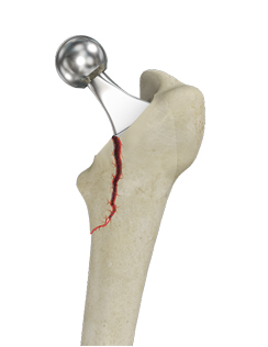 Femoral Fractures | Seacoast Orthopedics & Sports Medicine, Newburyport, MA