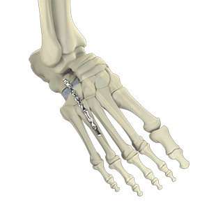 Charcot Reconstruction Lincoln NE | Osteotomy Omaha, Grand Island Fusion