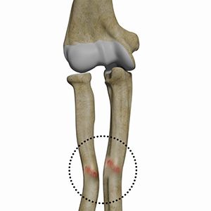 Malunion Surgery Omaha, Lincoln NE | Elbow Surgery Omaha, NE