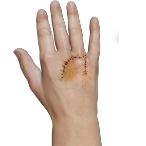 Microsurgical Flap Procedure Of The Hand Lincoln NE | Grand Island ...