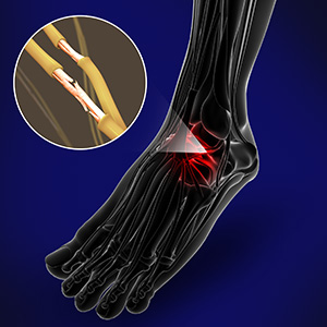 Nerve Conditions Of The Foot Lincoln NE | Morton’s Neuroma Omaha, Grand ...