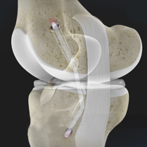 PCL Reconstruction Surgery Lincoln NE | PCL Injuries Omaha | PCL ...