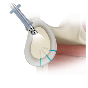 Shoulder Reconstruction Surgery Lincoln NE | Shoulder Instability Omaha ...