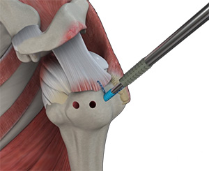 Arthroscopic Shoulder Stabilization Surgery Lincoln NE | Shoulder ...