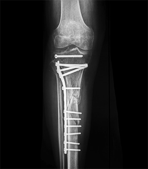 Traumatic Limb Salvage Surgery Lincoln NE | Limb Tumor Omaha, Grand Island