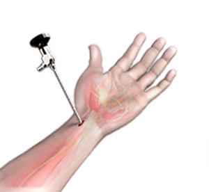 Wrist Arthroscopy Lincoln NE | Arthroscopic Wrist Surgery Omaha ...