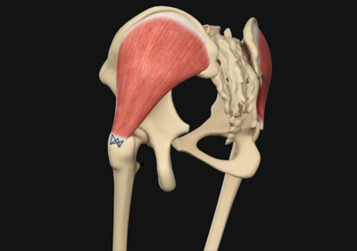 Gluteal Tendon Repair