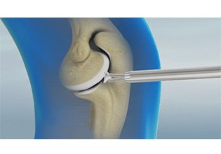 Arthroscopic Debridement of the Elbow Austin, TX | Minimally Invasive ...