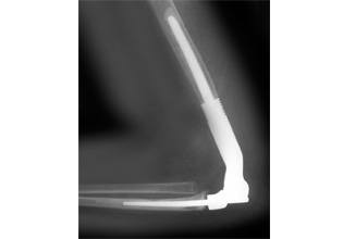 Distal Humerus Resection and Reconstruction in Austin, TX