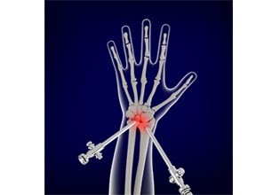 Distal Radioulnar Joint Arthroscopy Services in Austin, TX