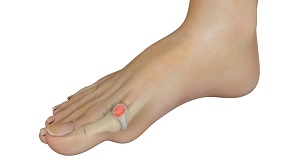 Cheilectomy Myrtle Beach | Stiff Big Toe Conway | Hallux Rigidus ...