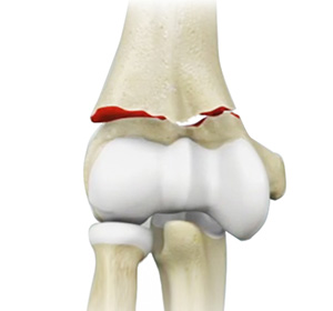 Elbow Fractures Treatment Conway SC | Elbow Trauma Horry County, Myrtle ...