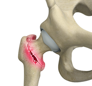 Hip Fracture Treatment Conway SC | Hip Pain Horry County | Myrtle Beach ...